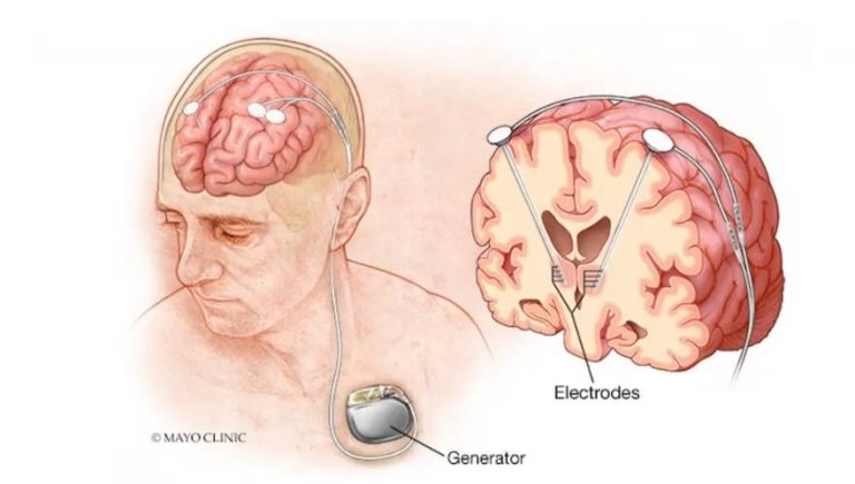 (VIDEO) When seizures don't stop: The battle against drug-resistant ...