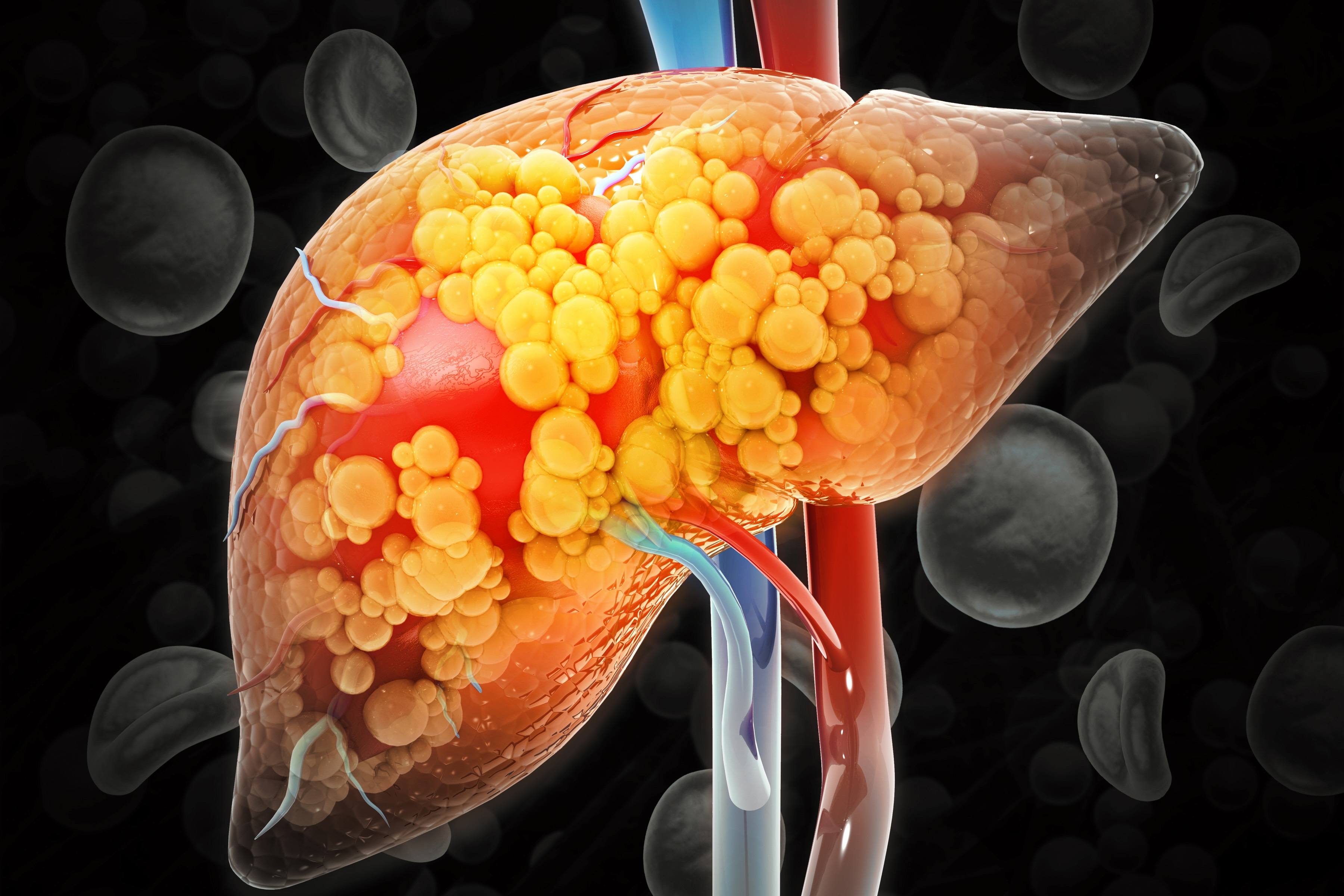 New study links genetic variation to chemotherapy-related liver damage ...