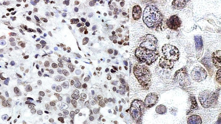 Mayo Clinic uncovers hidden driver fueling aggressive prostate cancer ...