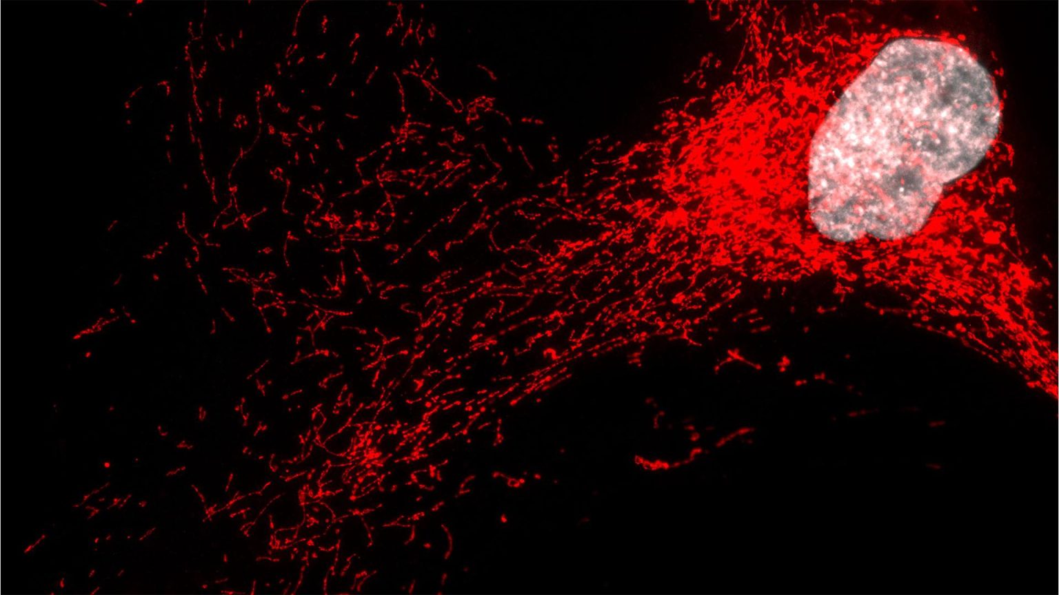 'Zombie' cells spark inflammation in severe fatty liver disease, Mayo ...