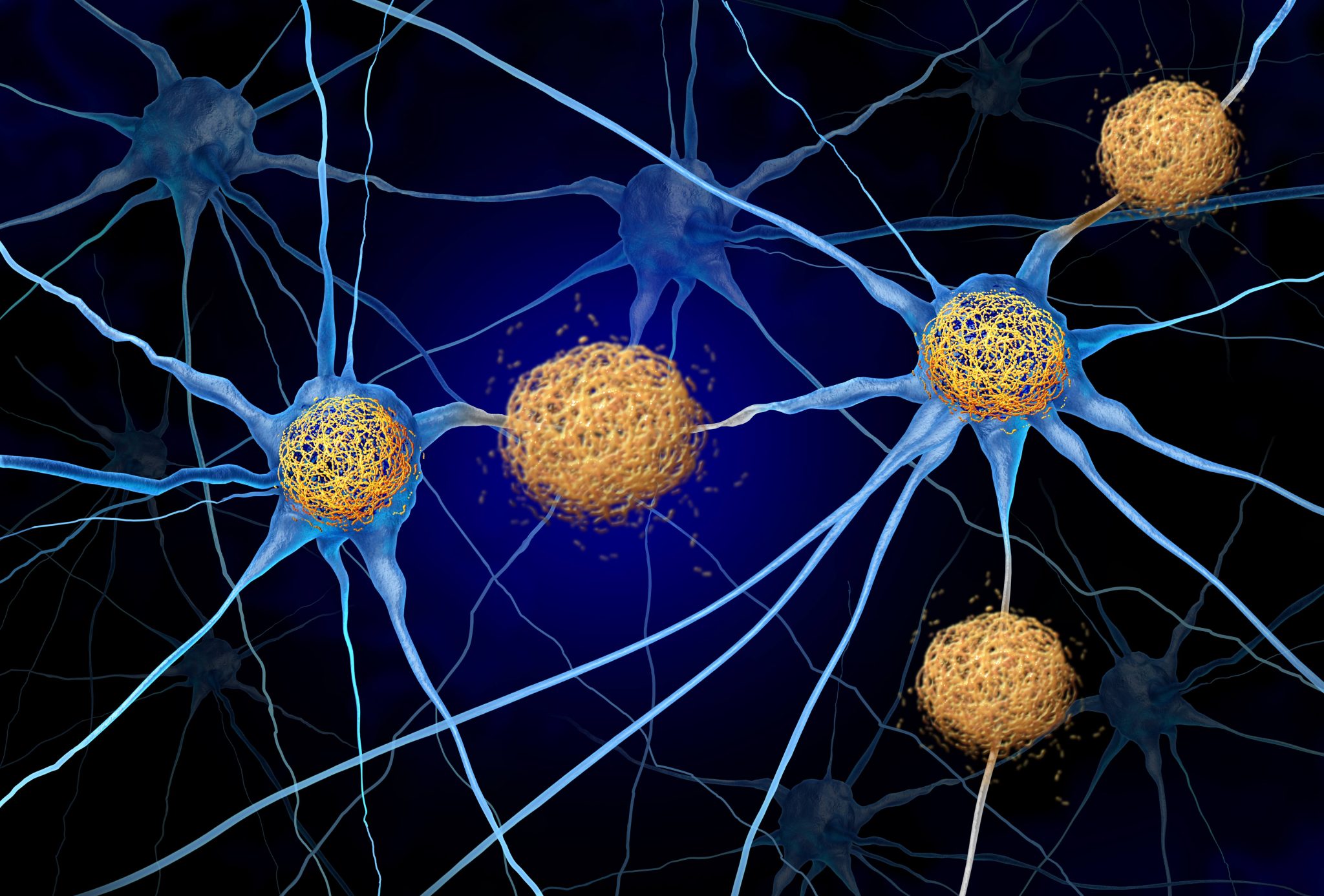Mayo Clinic researchers link Parkinson's-related protein to faster ...