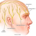 Mayo Clinic Minute: Treating severe headaches caused by nerve ...