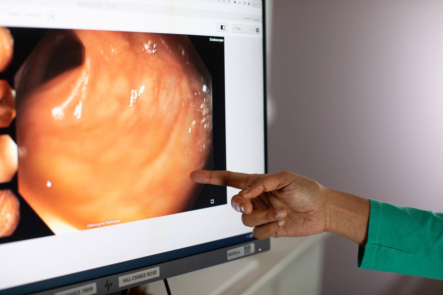 IA puede ayudar a predecir el riesgo de tener esófago de Barrett y ...